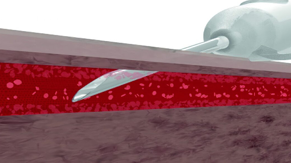 Peripheral IV Catheter System - SkyDance Vascular