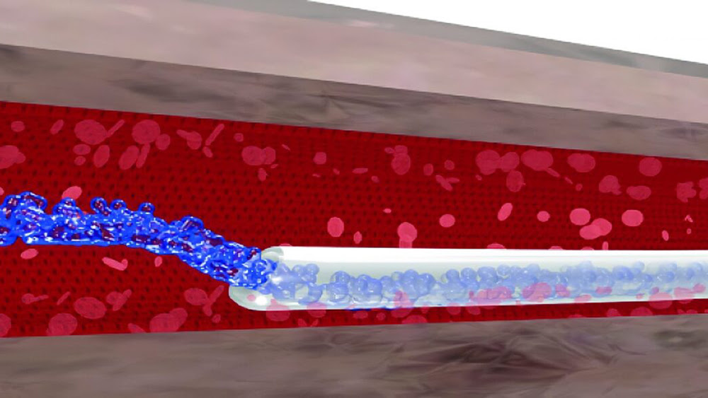 Peripheral IV Catheter System - SkyDance Vascular